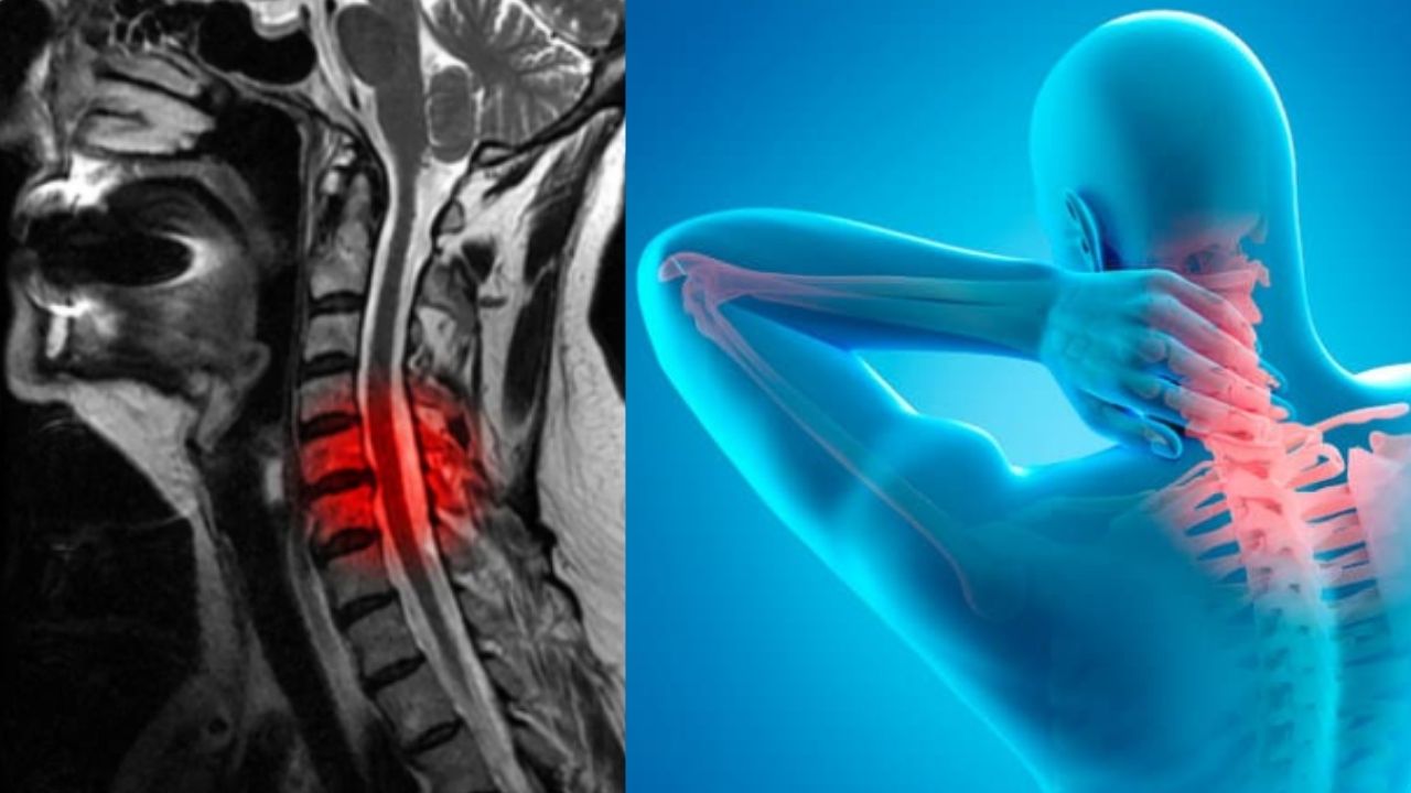 Boyun fıtığı nedir, neden olur, tanı ve tedavi yöntemleri, boyun fıtığı ...